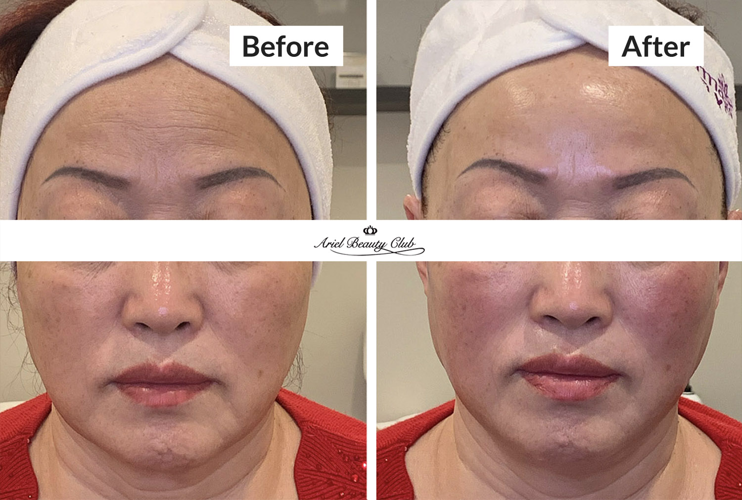 Thermage FLX Before & After - ARIEL BEAUTY CLUB